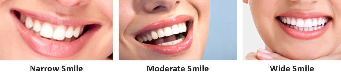 Complete Smile Dental In India Perfect Smile Design Dentistry Complete Smile Dental In India Perfect Smile Design Dentistry